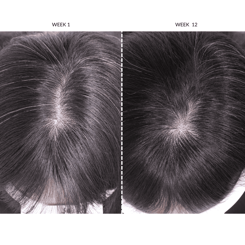 LED Hair Growth Helmet | Red Light Therapy for Hair Loss | CurrentBody ...